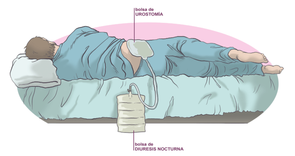 Vivir con una urostomía (información para pacientes) – Urología Basada ...