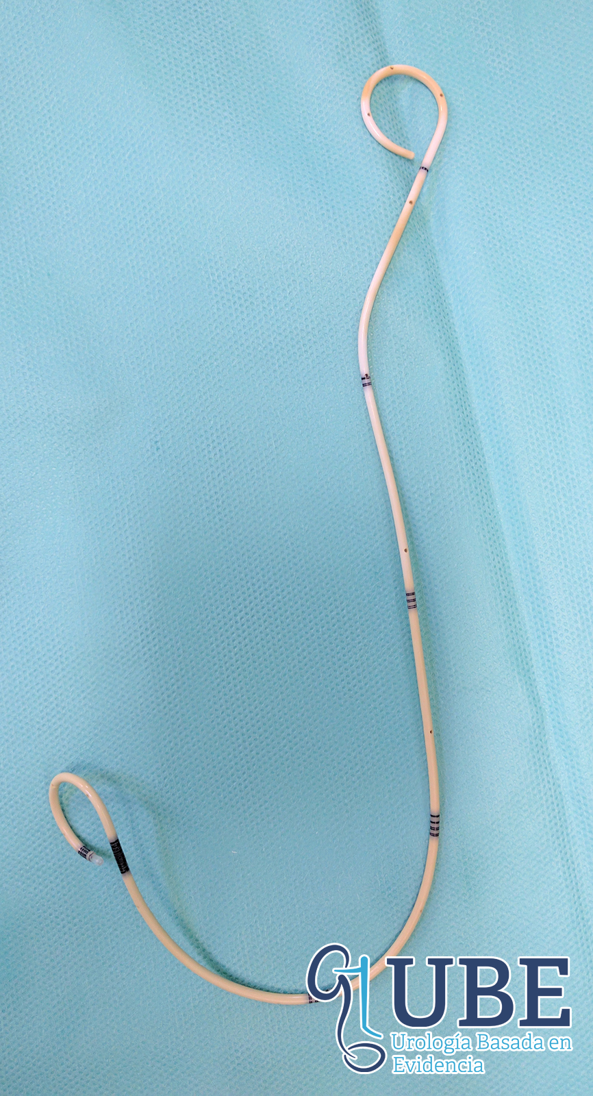¿Qué es un catéter doble J? – Urología Basada en Evidencia