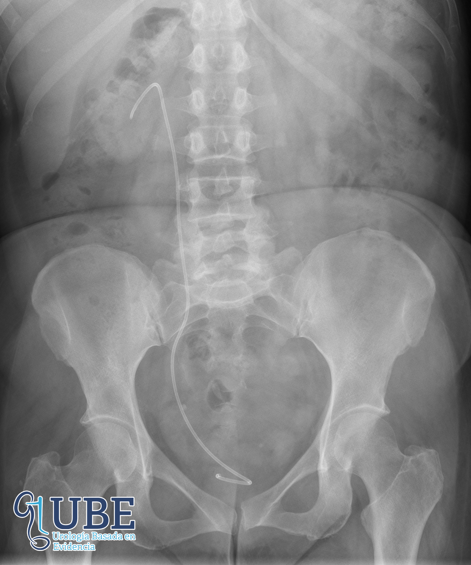 ¿Qué es un catéter doble J? – Urología Basada en Evidencia